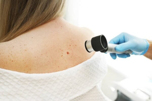 Recognizing the Warning Signs of Skin Cancer: Early Detection ...